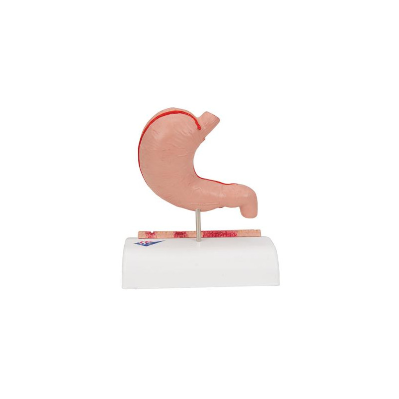 3B Scientific stomach section model with ulcers | Medi-Shop.gr