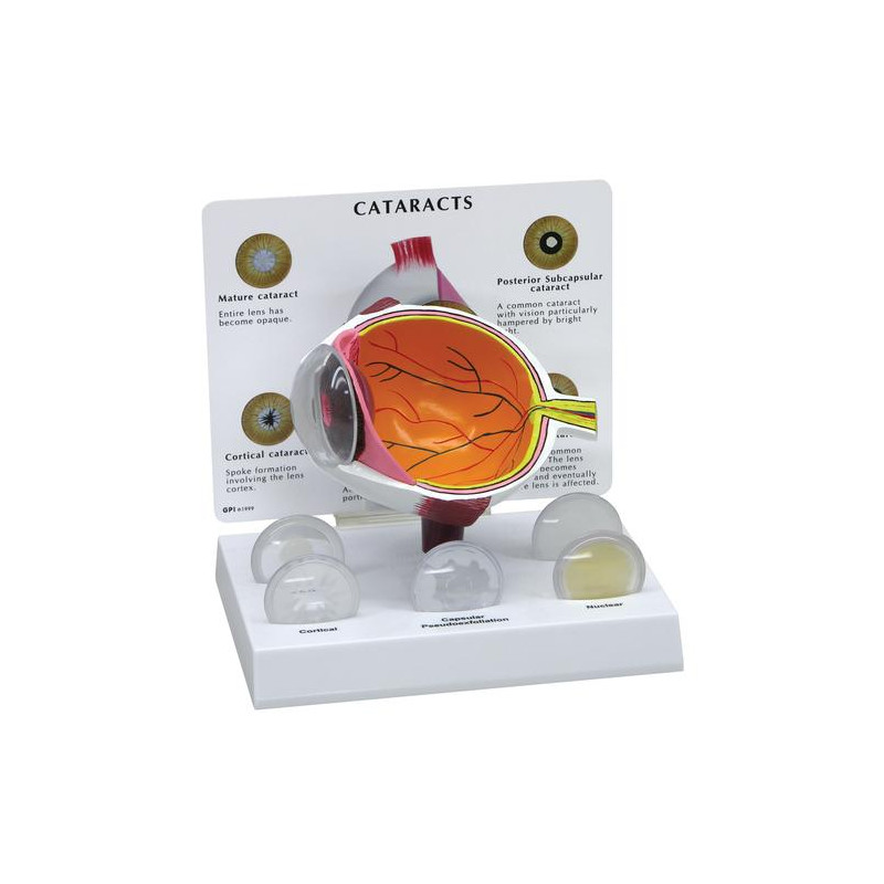 Πρόπλασμα ματιού με καταρράκτη GPI Anatomicals | Medi-Shop.gr